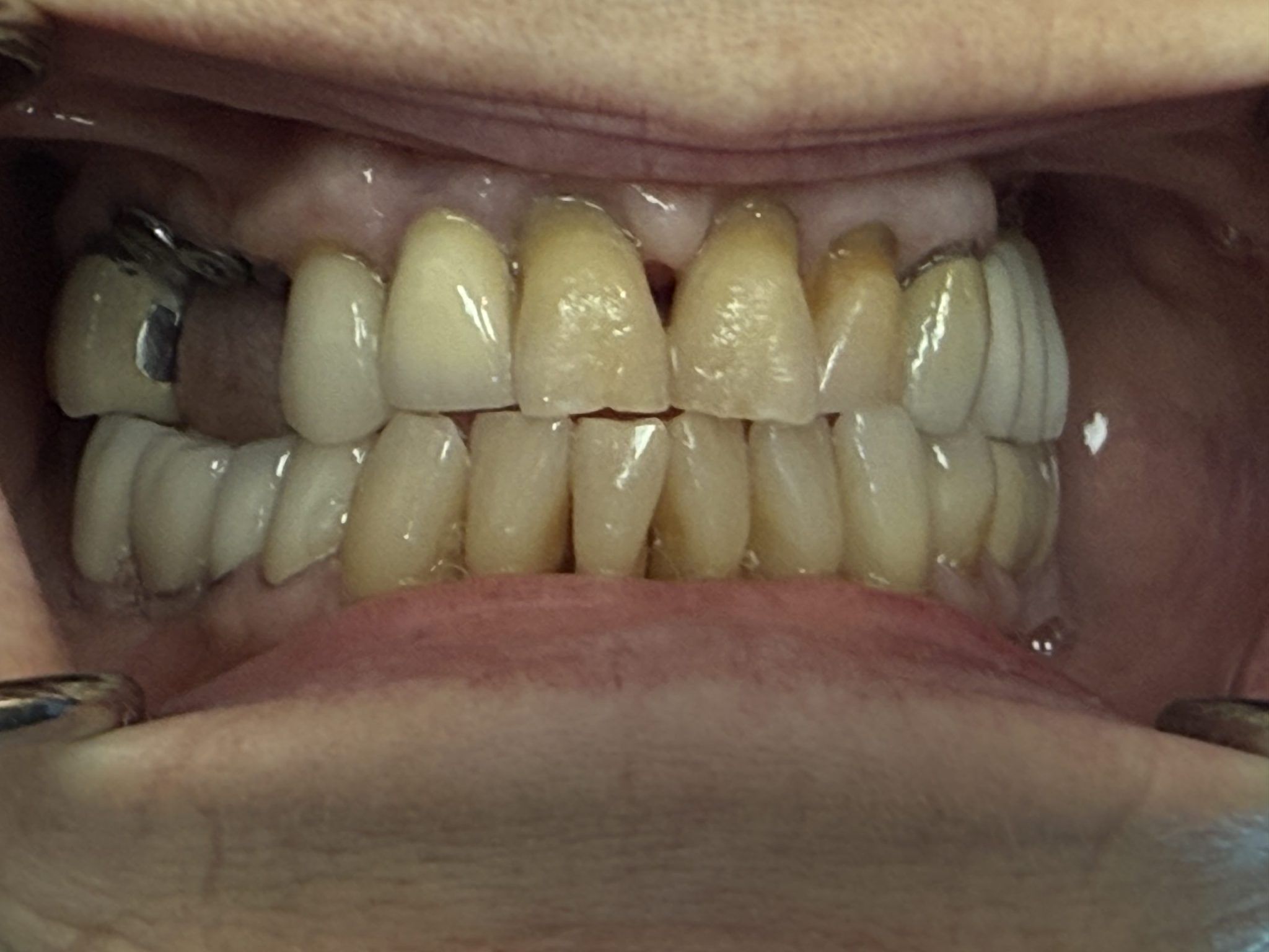 Implant Temporary Bridge: How It Works, Before & After | TDS