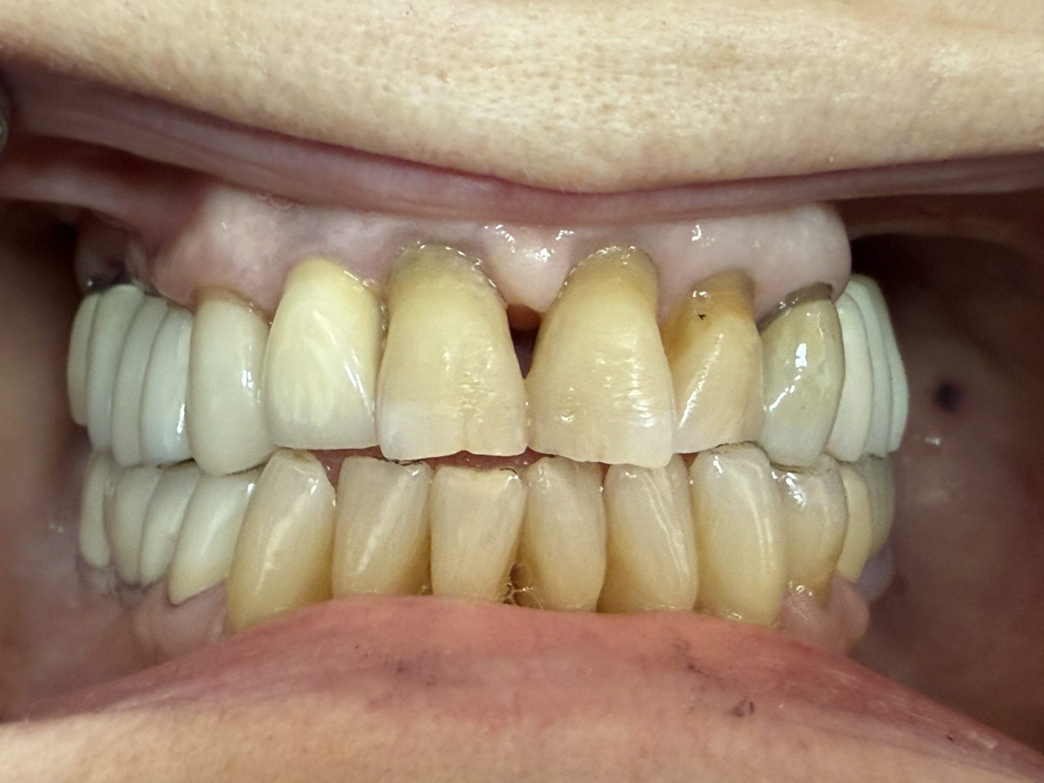 Implant Temporary Bridge: How It Works, Before & After | TDS